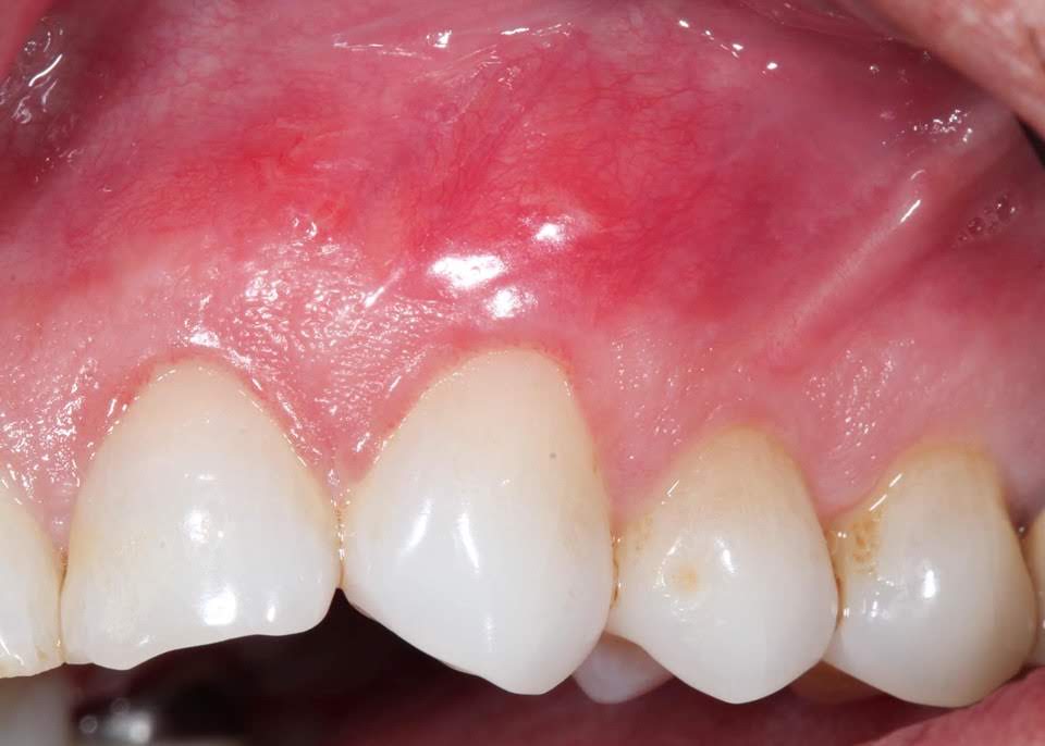 Modified Pin Hole Graft - Wilmington Dental Implants